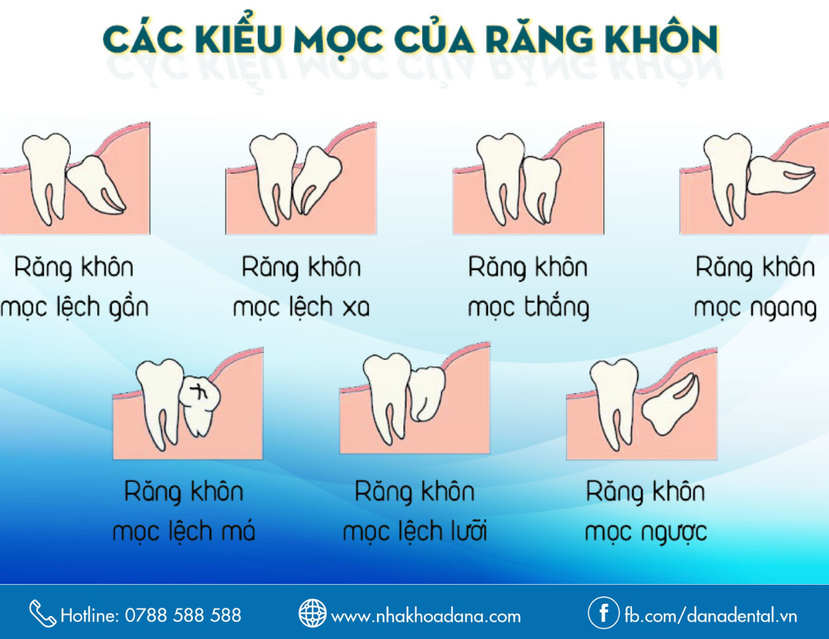 Nhổ răng khôn Đà Nẵng ở đâu không đau?