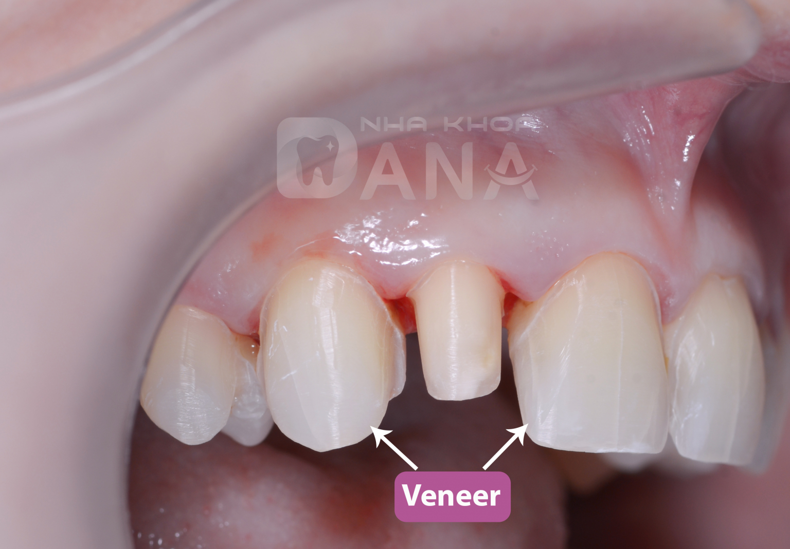 Mặt Dán Sứ Veneer mài tối thiểu tại Đà Nẵng » Dana Dental